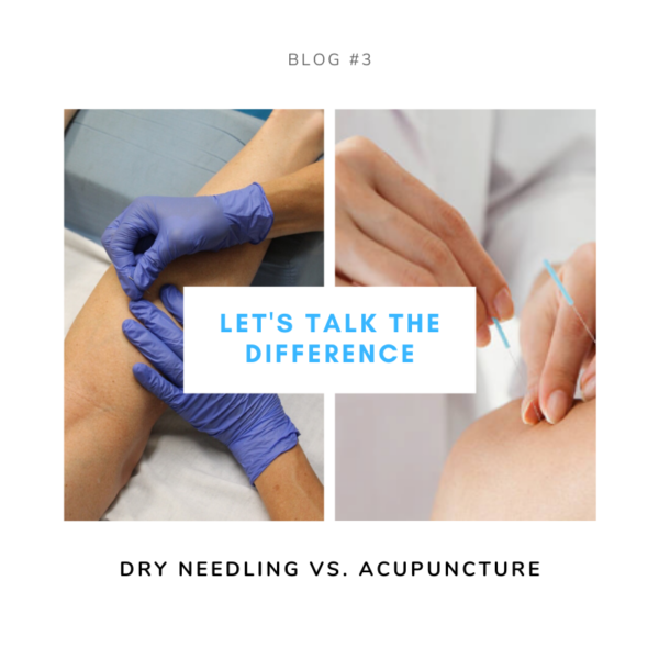 Let's Talk the Difference: Dry Needling vs. Acupuncture | KCP Charlotte
